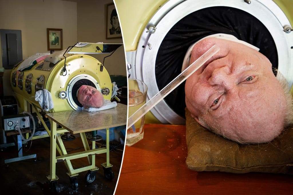 FALLECIÓ PAUL ALEXANDER, EL HOMBRE DEL PULMÓN DE ACERO